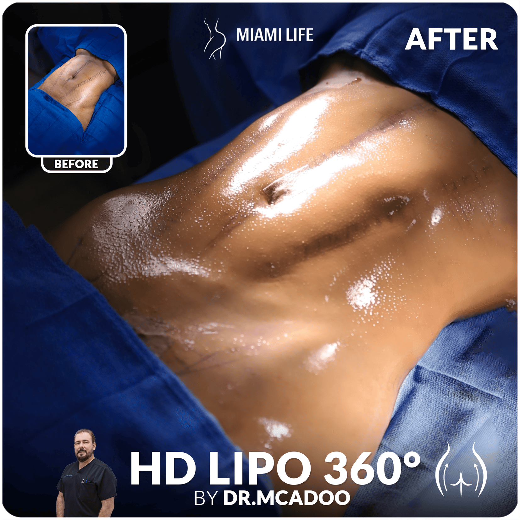 What is HD Lipo 360 with AB Etching? – Miami Life Cosmetic Surgery